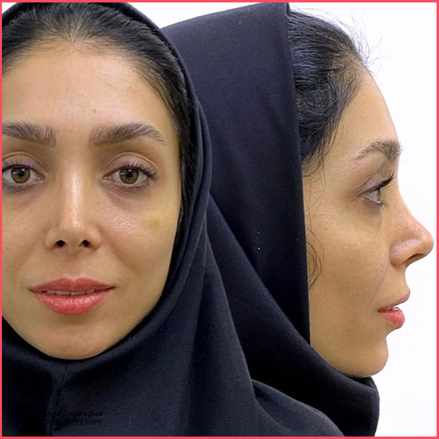 المواصفات والسعر وشراء تجميل الأنف | الدكتور ابراهيم رزم با