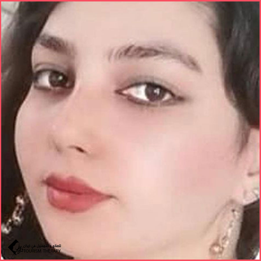 المواصفات والسعر وشراء تجميل الأنف | الدكتور مجتبى ملكي