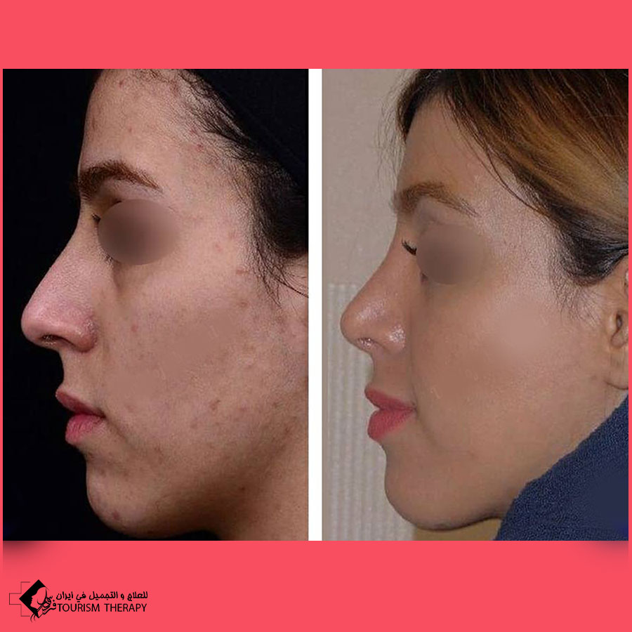 المواصفات والسعر وشراء تجميل الأنف | الدكتور مجتبى ملكي