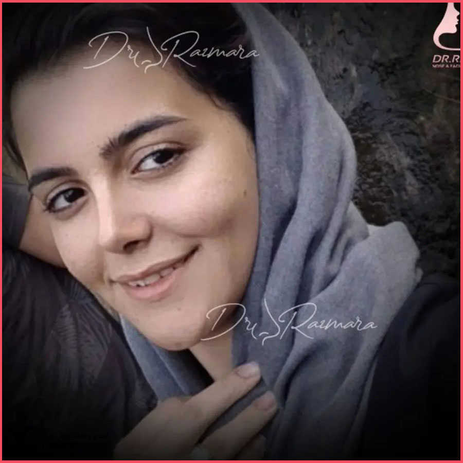 المواصفات والسعر وشراء تجميل الأنف | الدكتورة نرجس رزم آرا