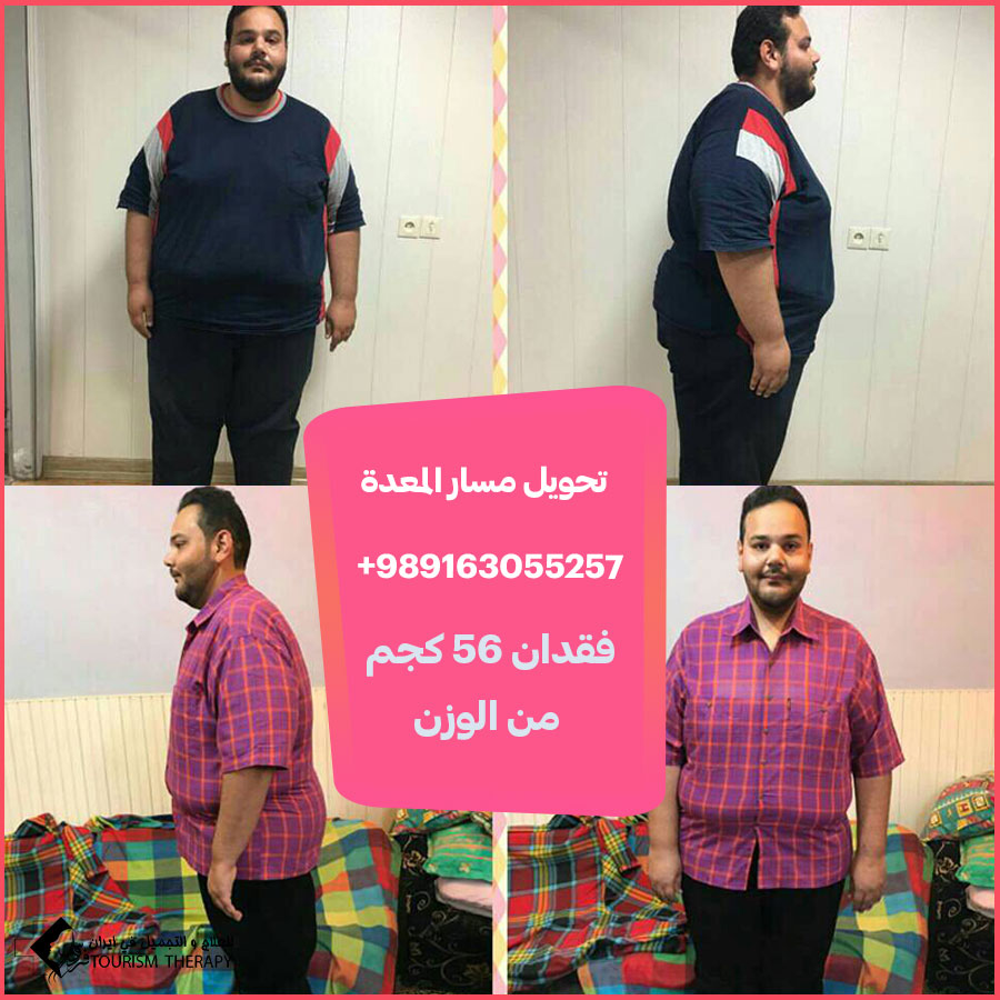 المواصفات والسعر وحجز موعد تحويل مسار المعدة في شيراز | الدكتور محمد رجايي