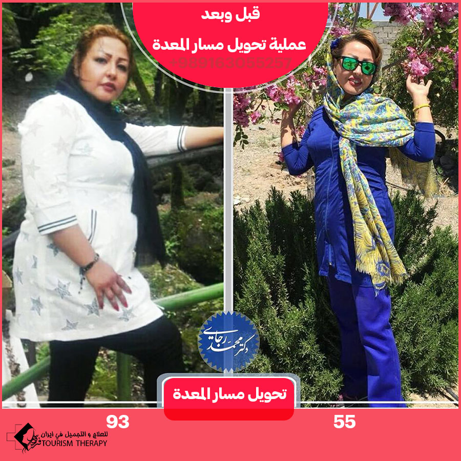 المواصفات والسعر وحجز موعد تحويل مسار المعدة في شيراز | الدكتور محمد رجايي