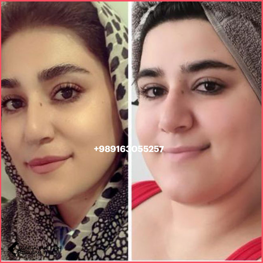 المواصفات والسعر وحجز موعد تحويل مسار المعدة في شيراز | الدكتور محمد رجايي