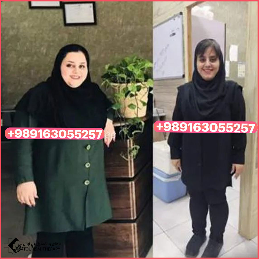 المواصفات والسعر وحجز موعد تحويل مسار المعدة في شيراز | الدكتور محمد رجايي