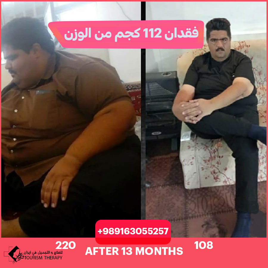 المواصفات والسعر وشراء ثنائي تقسيم المعدة في شيراز | الدكتور محمد رجايي