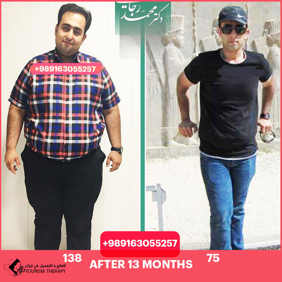 المواصفات والسعر وشراء ثنائي تقسيم المعدة في شيراز | الدكتور محمد رجايي