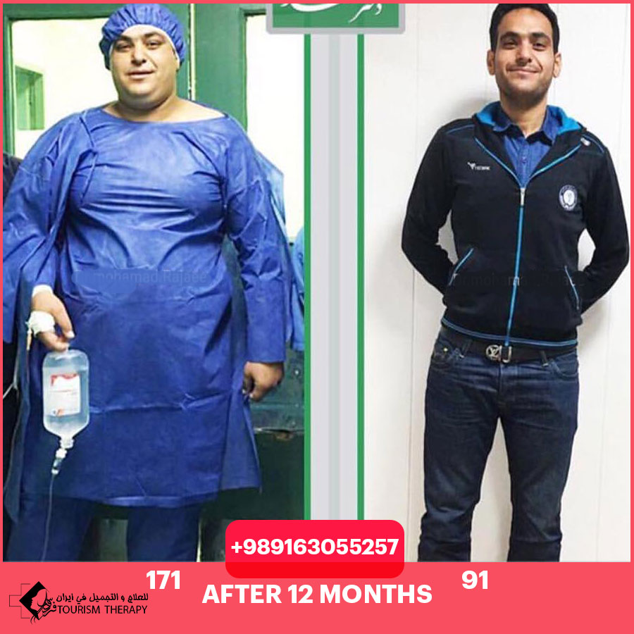 المواصفات والسعر وشراء ثنائي تقسيم المعدة في شيراز | الدكتور محمد رجايي