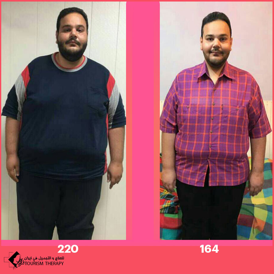 المواصفات والسعر وحجز موعد تحويل مسار المعدة في شيراز | الدكتور محمد رجايي